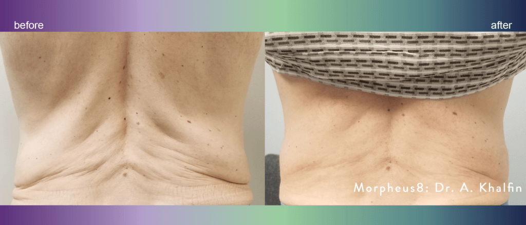 Skin Tightening Treatment for Face and Body (Morpheus 8) - Family ...